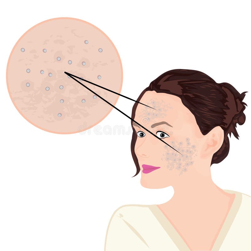 Acne Stock Illustrations – 6,772 Acne Stock Illustrations, Vectors ...