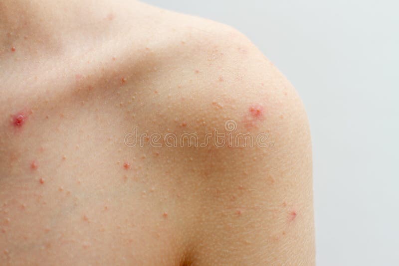 Acne Female Body with Skin in Pimples Stock Image - Image of ...