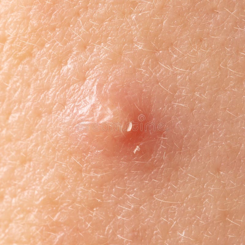 Acne on the Human Skin As a Background Stock Photo - Image of close ...