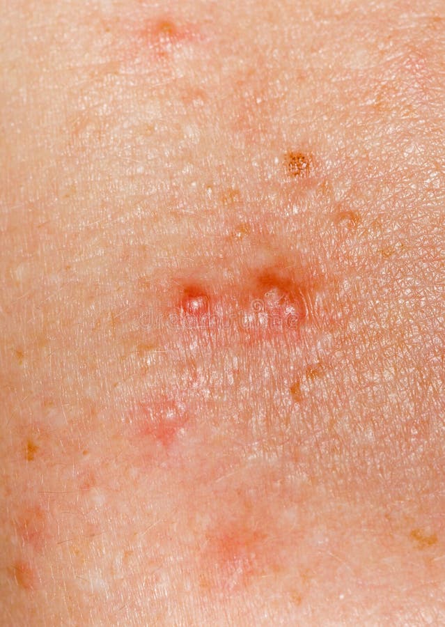 Pimple on human skin macro stock photo. Image of chest - 28627564