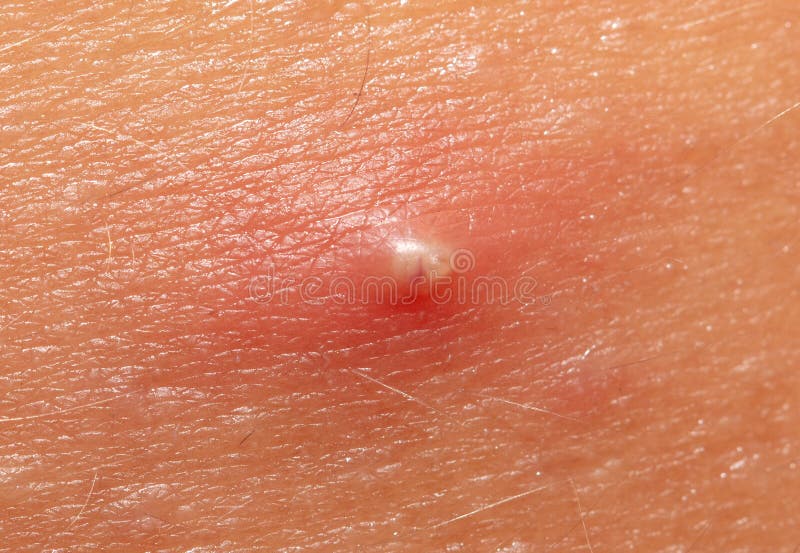 Acne on the Human Skin that is Caused by the Cover Stock Photo - Image ...