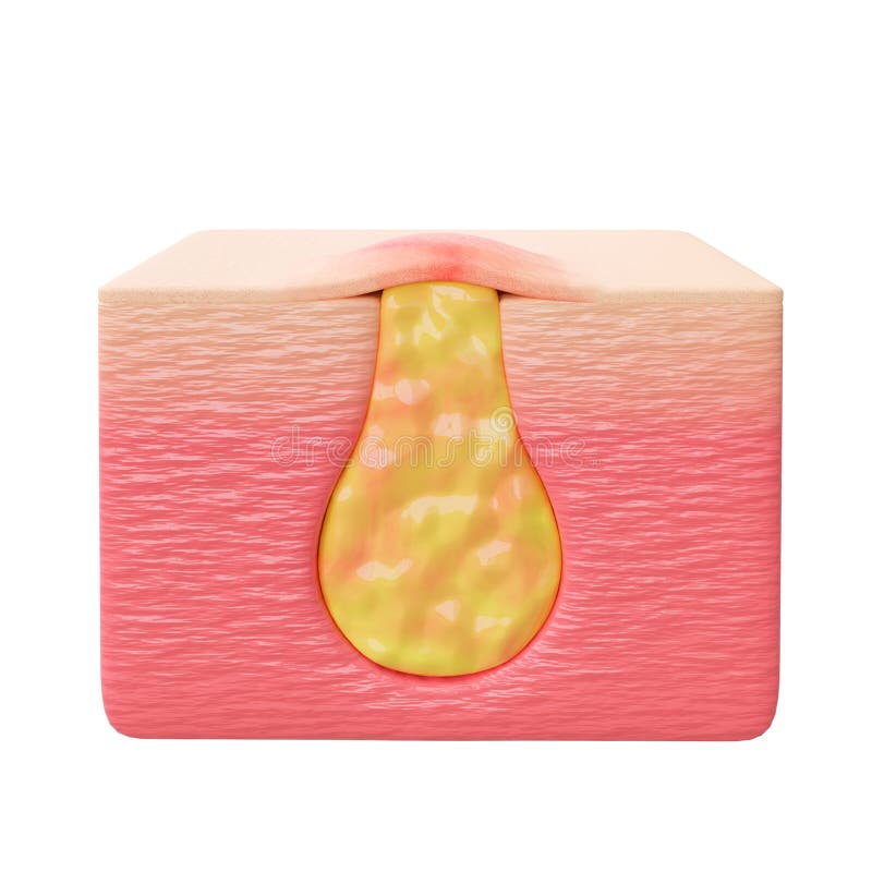 Acne is the Inflammatory Process of the Sebaceous Glands and ...