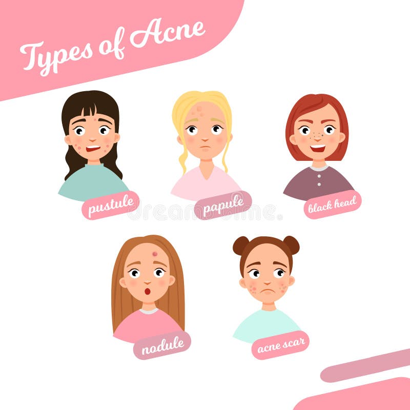 Acne infographics. stock vector. Illustration of infection - 122414012