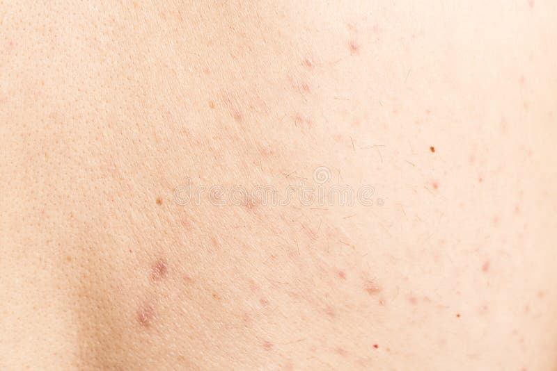 Acne on male man back stock image. Image of problem, clean - 68656757