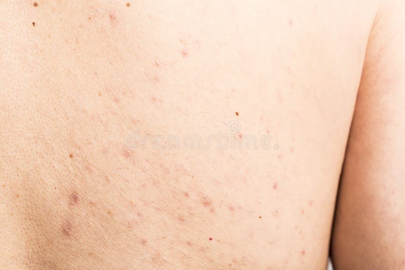 Acne on male man back stock image. Image of health, disease - 68657305