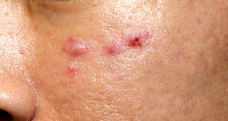 Nodular cystic acne skin stock photo. Image of allergy - 67317208