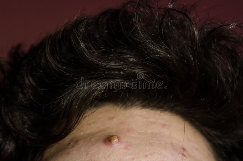 An acne on man`s forehead stock image. Image of body - 143491477