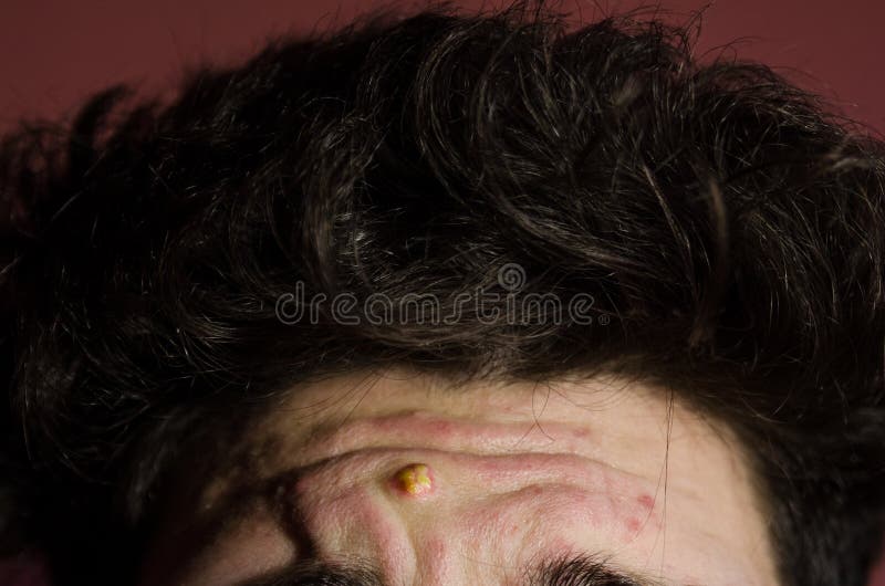 An acne on man`s forehead stock photo. Image of beauty - 143491614