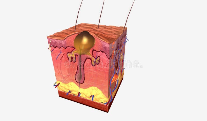 Comedone Stock Illustrations – 353 Comedone Stock Illustrations ...