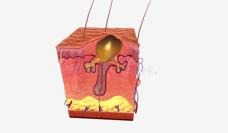 Comedone Stock Illustrations – 353 Comedone Stock Illustrations ...