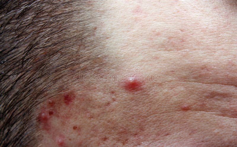 Acne pimples on the face stock image. Image of poor, hygiene - 38634691