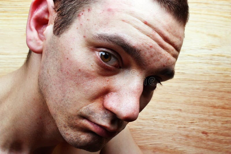 Acne pimples on the face stock photo. Image of face, chronic - 38111318