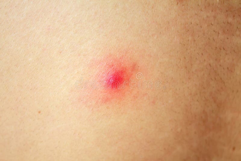 Acne with red spots stock image. Image of back, medical - 96818689
