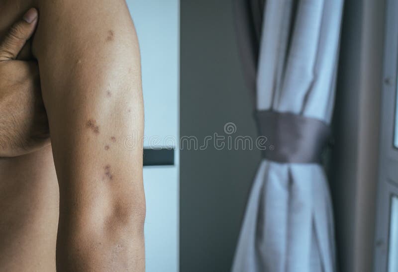 Acne Scars Black Color with Problematic Problem Skin Closeup Stock ...