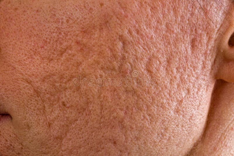 Deep Acne Scars Stock Photos - Free & Royalty-Free Stock Photos from ...
