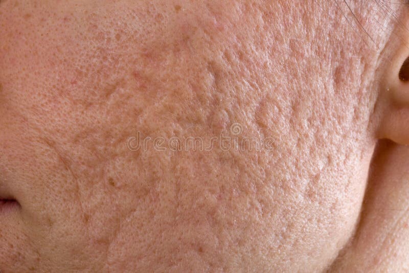 Acne scars on cheek stock photo. Image of pimple, pores - 47291702