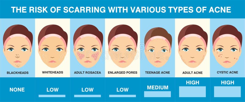 Acne Scars. Different Types of Acne. Infographics Stock Vector ...