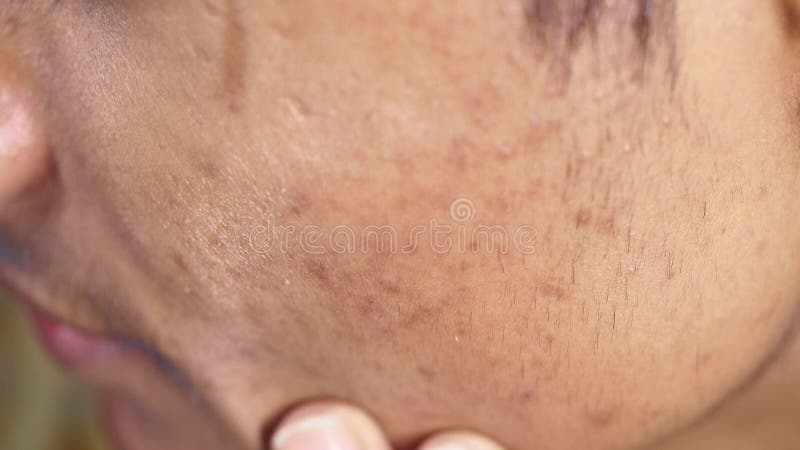 Acne Scars and Marks on Face Stock Video - Video of damaged, condition ...