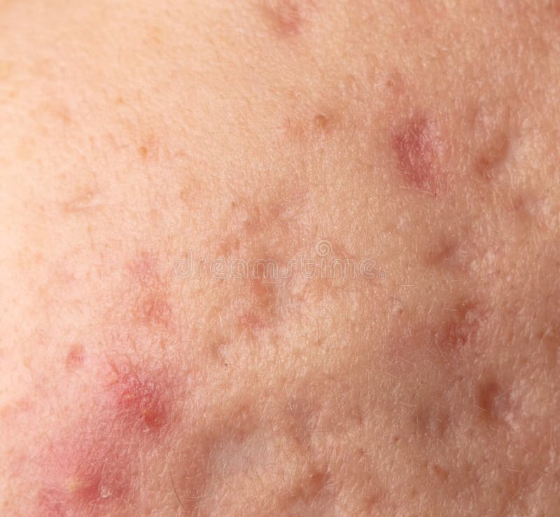 Acne Scars on the Skin. Macro Stock Image - Image of acne, teenager ...