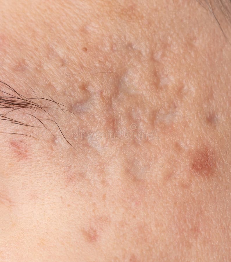 Acne Scars on the Skin. Macro Stock Image - Image of blemish, healthy ...