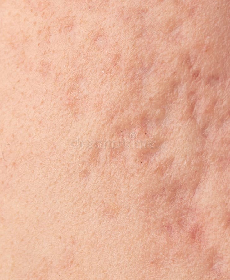 Acne Scars on the Skin. Macro Stock Image - Image of macro, skin: 274049263