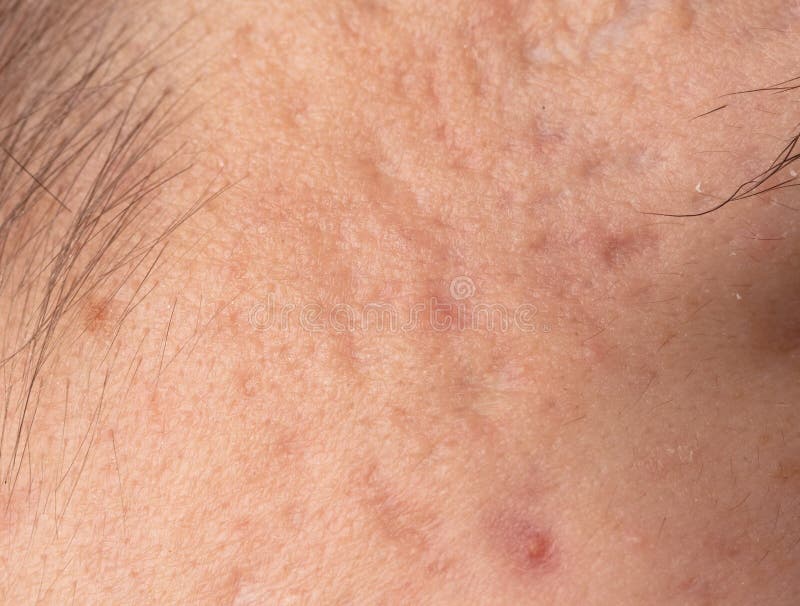 Acne Scars on the Skin. Macro Stock Image - Image of health, female ...