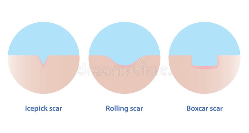 Types of Inflammatory Acne, Papule, Pustule, Nodule and Cyst Vector on ...