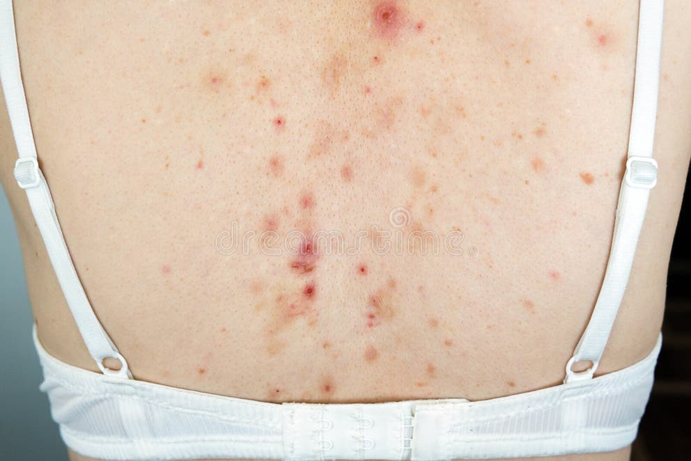 Acne Sequelae, Torn Pimples, Skin Itching on the Back, Dermatological ...