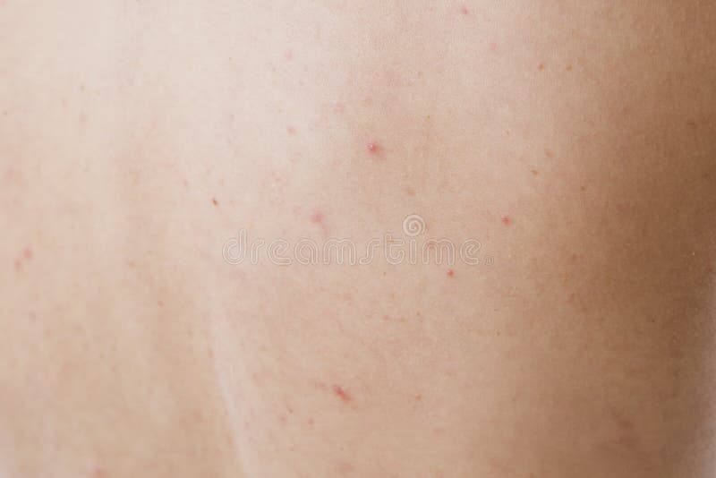 Acne skin close-up stock photo. Image of health, contagion - 47995566
