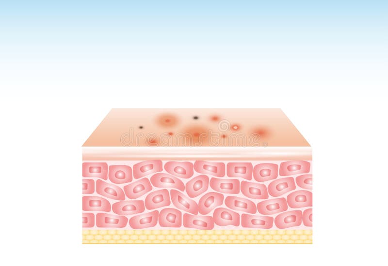 Acne Skin Spot Pimple Problem Vector Design Stock Vector - Illustration ...