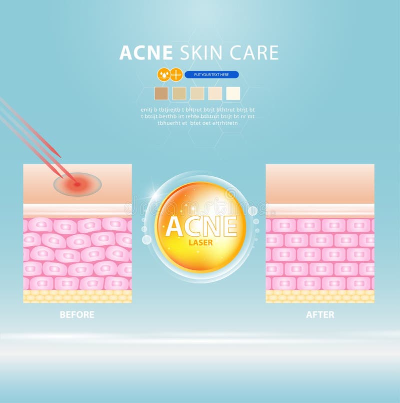 Acne Skin Spot Pimple Problem Vector Design Stock Vector - Illustration ...