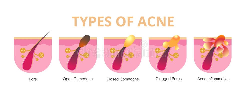 Acne, Stages of Development, Healthy Skin, Vector Design Stock ...