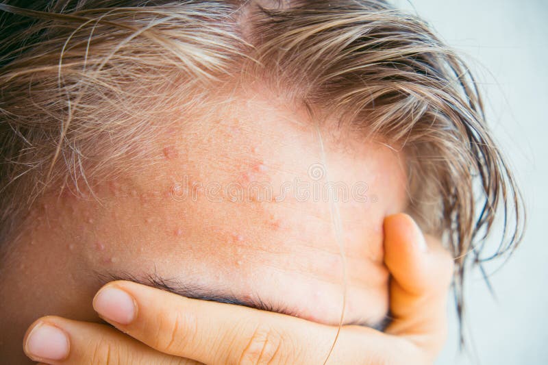 Acne on Teenage Boy Forehead. Child is Upset because of Skin Problems ...