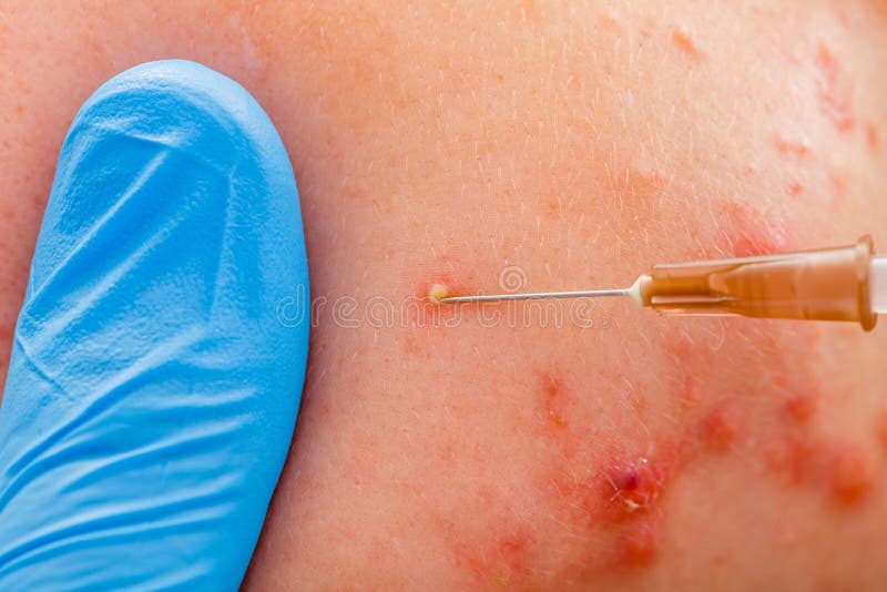 Acne treatment stock photo. Image of hormone, dermatology - 37788612