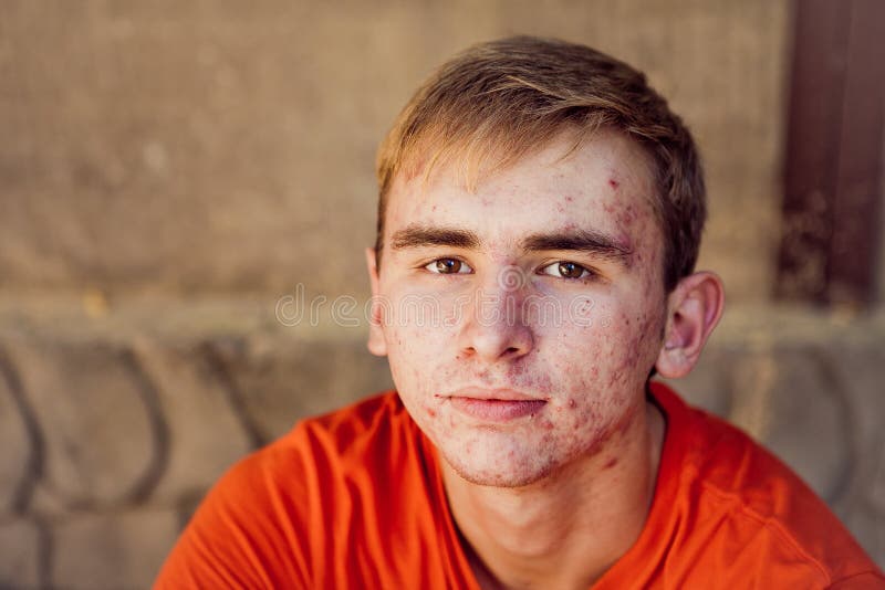 Acne stock image. Image of malnutrition, acne, face, inflammation ...