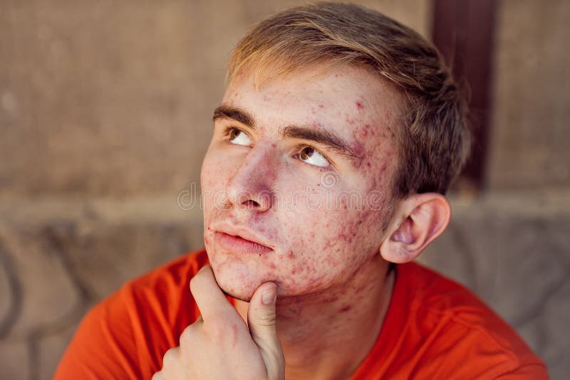 Acne stock image. Image of problem, acne, inflammation - 77292949
