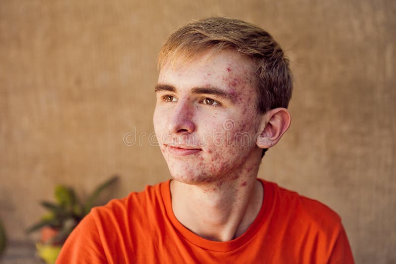 Close Up of Young Attractive Man with Problematic Skin and Scars from ...