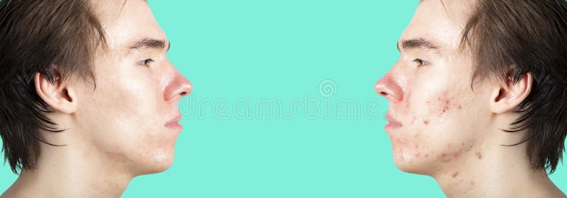 Acne. a Young Man with Acne on His Face Stock Image - Image of allergy ...