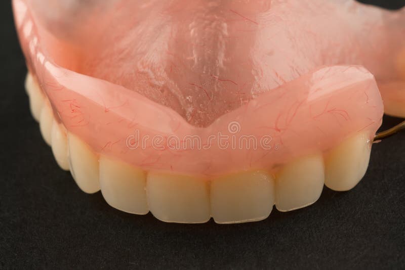 Acrylic Dental Prosthesis with Metal Retaining Elements Stock Image ...