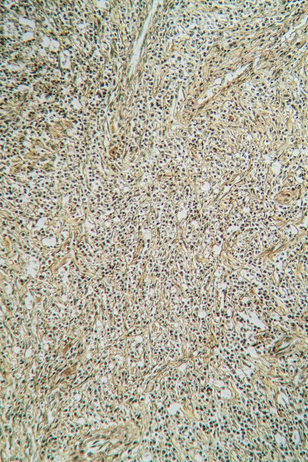 Actinomyces Disease Under the Microscope Stock Photo - Image of cattle ...