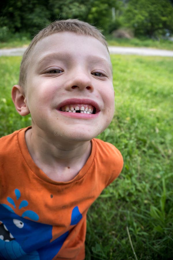 Small Child Lost the First Tooth Stock Photo - Image of glove, active ...