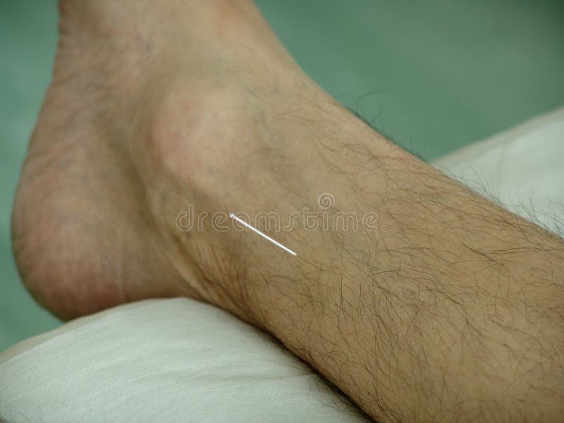 Acupuncture stock image. Image of meridian, acupuncture - 359797