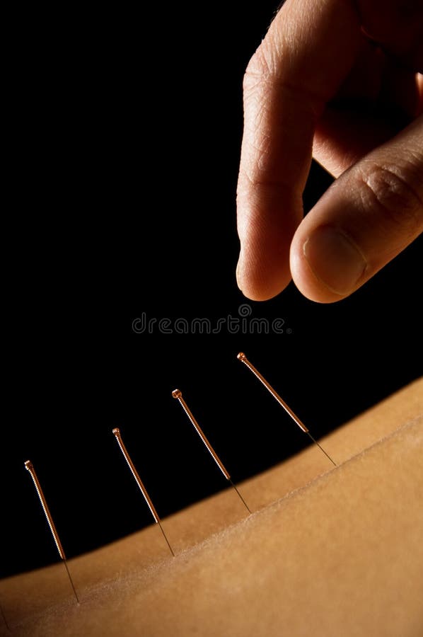 Acupuncture stock image. Image of health, fresh, chinese - 5182277