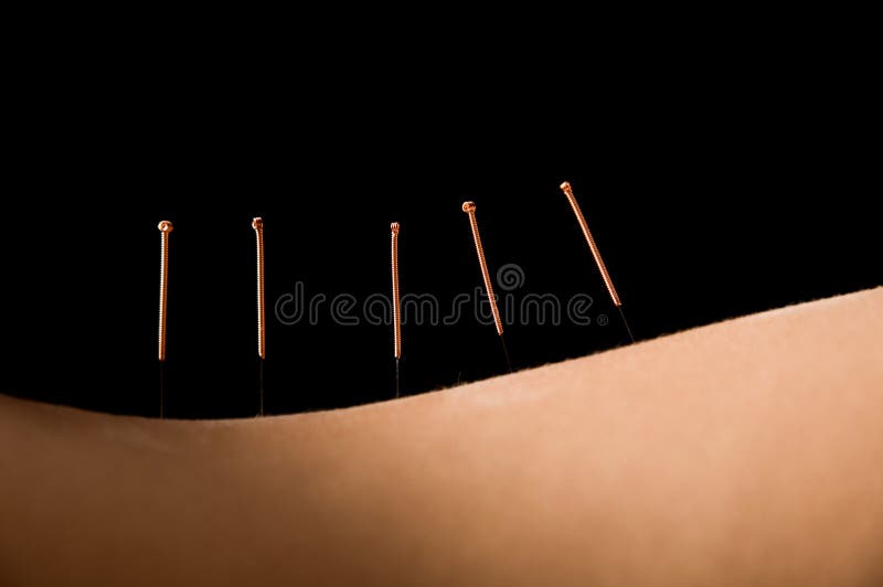 Acupuncture stock image. Image of beauty, massage, lady - 5221565