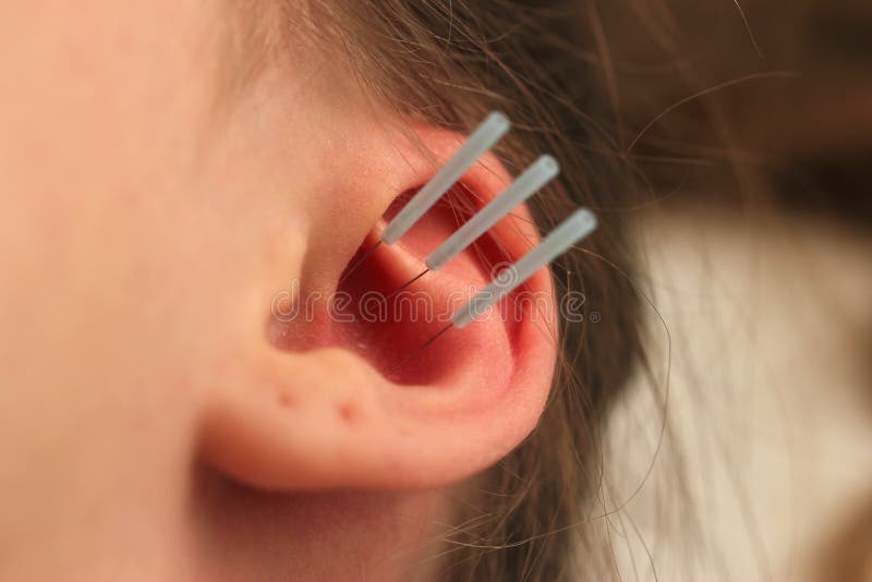 Acupuncture of the Ear with Three Needles, Ear with Holes Stock Image ...