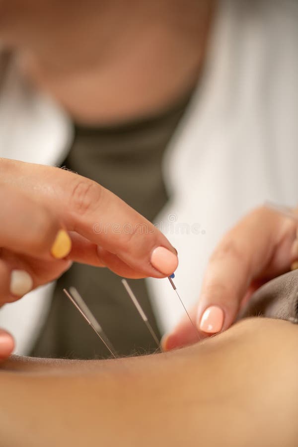 Acupuncture for Lower Back Pain Stock Image - Image of needling, back ...