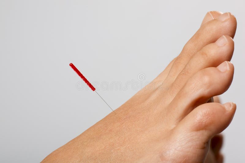 Acupuncture needle in foot stock image. Image of horizontal - 7280077