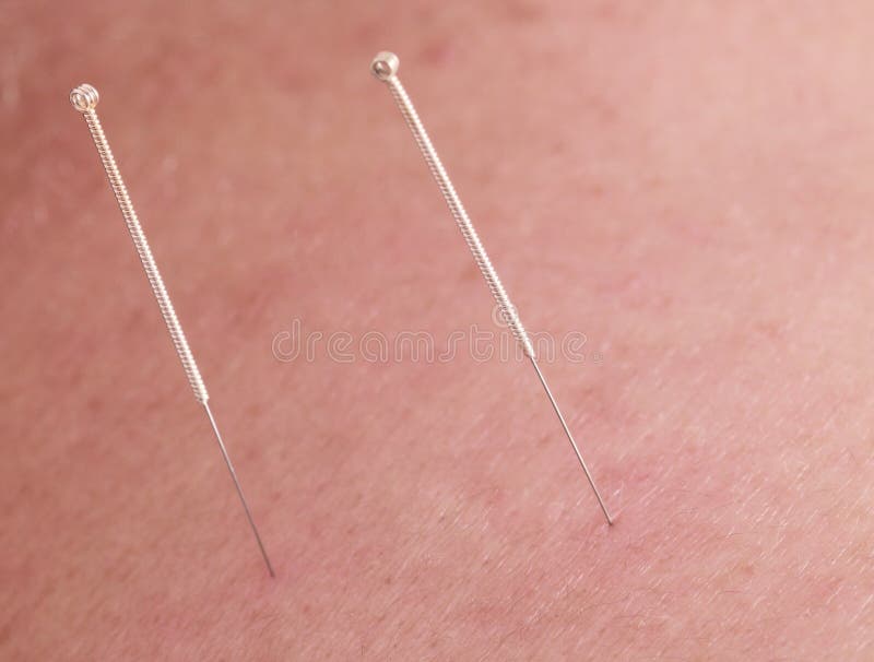 Acupuncture Needle stock photo. Image of chinese, filiform - 13474798