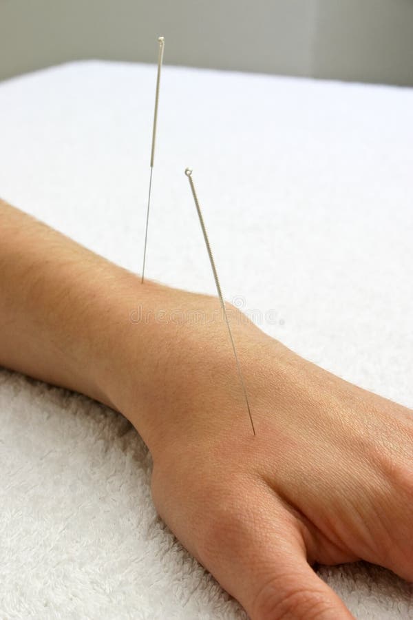 Acupuncture Needles in Hand Stock Image - Image of acupuncture ...