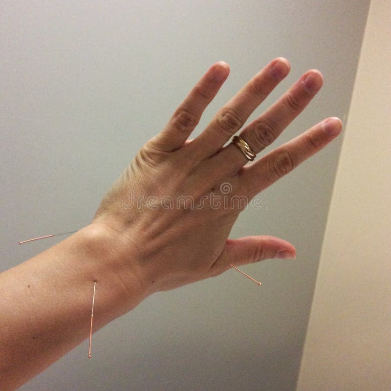 Acupuncture session stock image. Image of needles, holistic - 42490239